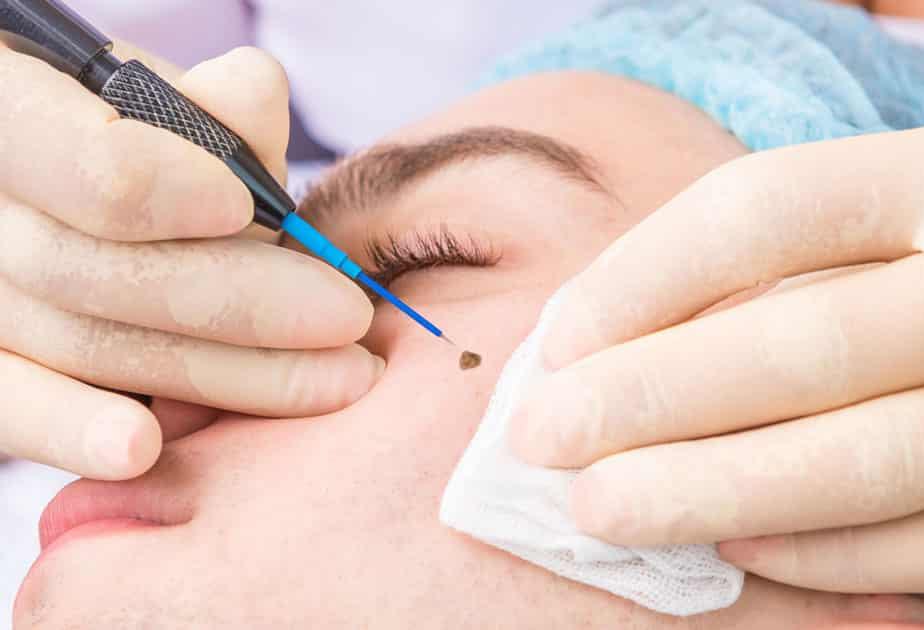 Wart Removal | M A Skin & Hair Superspeciality Clinic - Dr. Manoj ... Wart Removal | M A Skin & Hair Superspeciality Clinic - Dr. Manoj ...